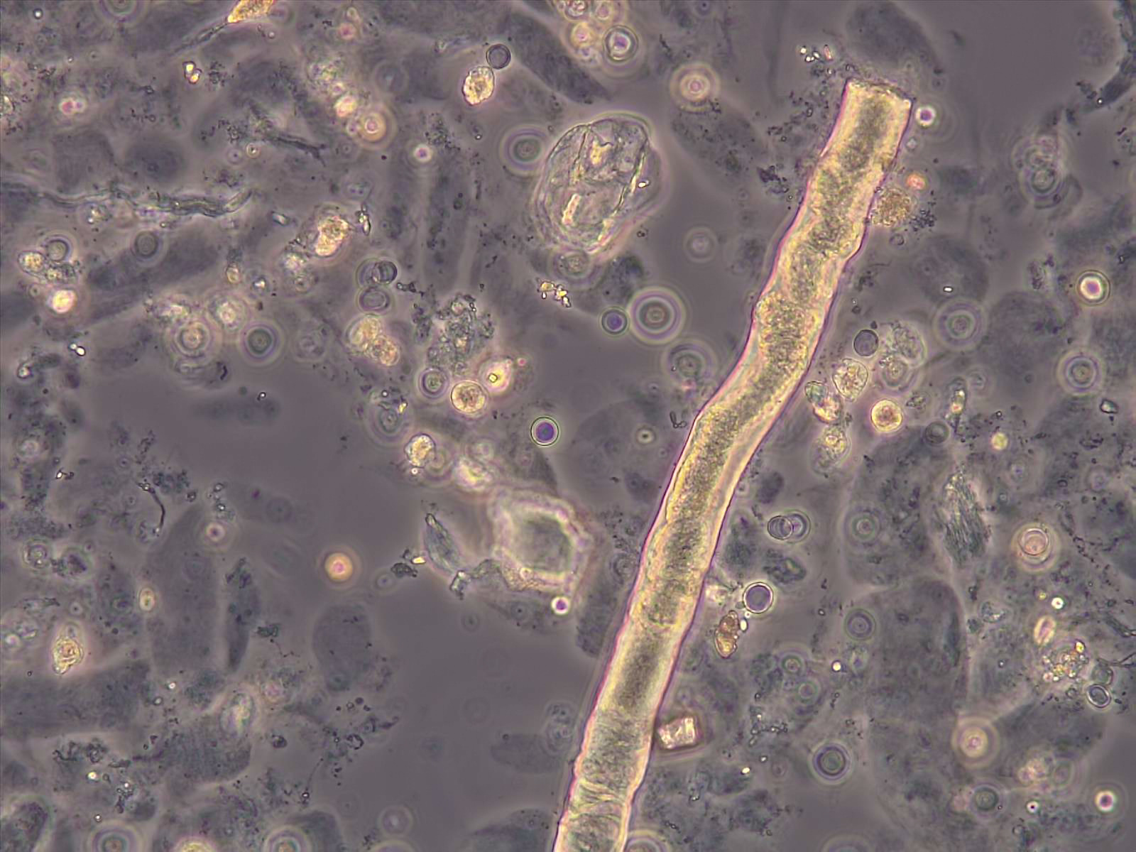 Waxy cast | CellWiki